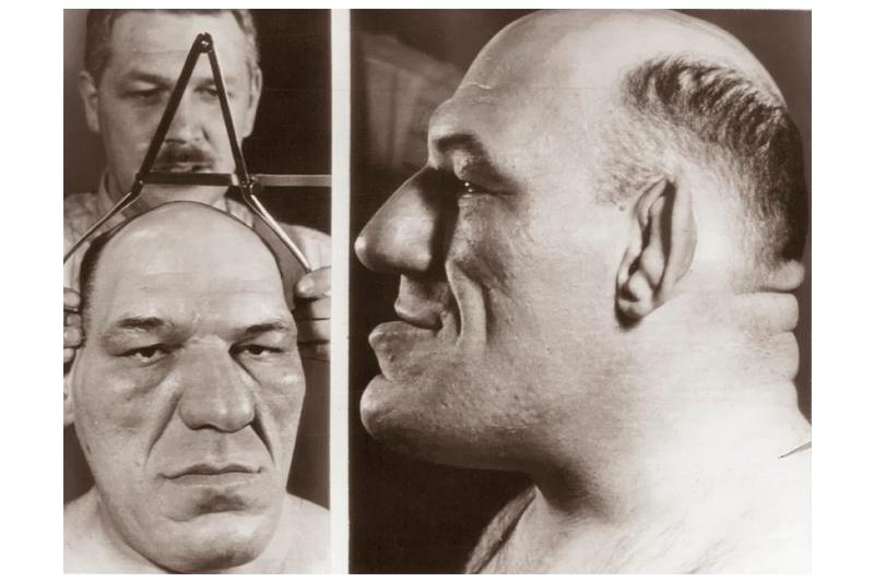 Акромегалія: причини, симптоми і лікування