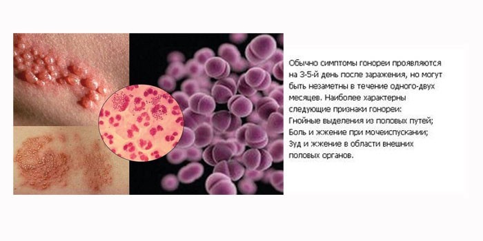 Гонорея - причини виникнення, інкубаційний період та методи лікування